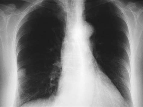 Nódulo Solitario Del Pulmón Valoración Radiográfica