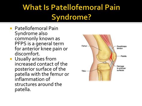Patellofemoral Pain Syndrome Pfps Physioflow