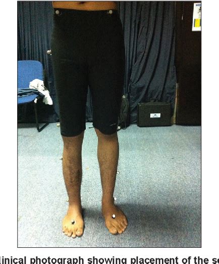 Figure 1 From Gait Analysis In Patients With Wide Resection And Endoprosthesis Replacement