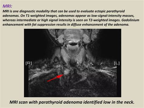 Presentation1 Radiological Imaging Of Hyperparathyroidism Pptx