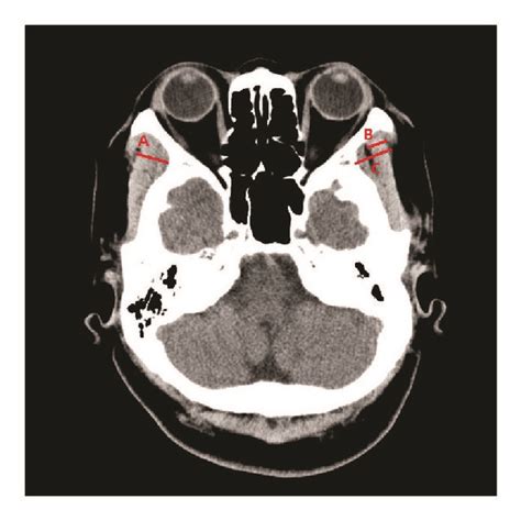 Operative Photographs Showing Steps Of Left Frontotemporal Craniotomy