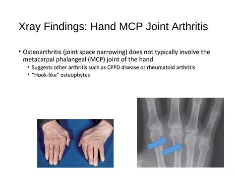 Crystal Induced Arthritis Carlin Ppt