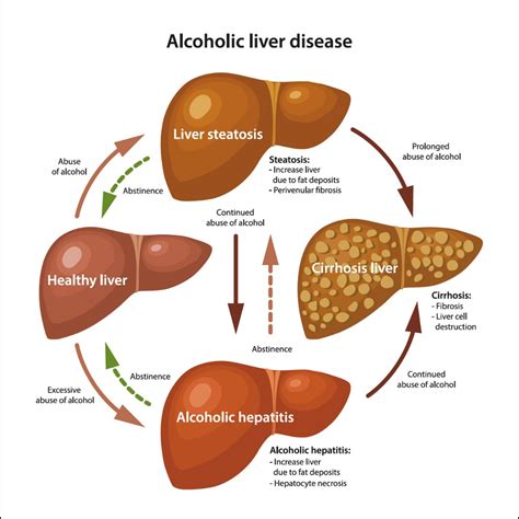 Cirrhosis As Related To Alcoholic Liver Disease Pictures Alcoholic