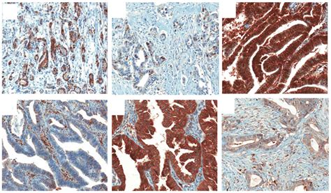 Expression Of Thymidylate Synthase Ts Thymidine Phosphorylase Tp Download Scientific