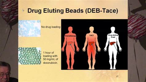Spheres Vs Chemoembolization Vs Bland Embolization Which Is Best