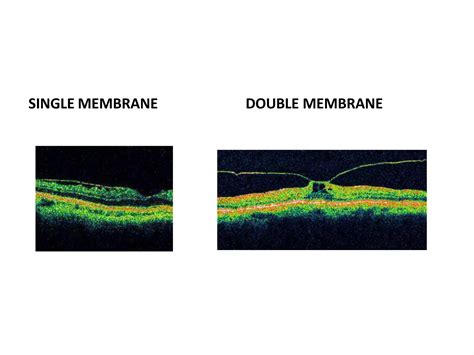 Optical Coherence Tomographyoct Macula Pptx Eye And Vision