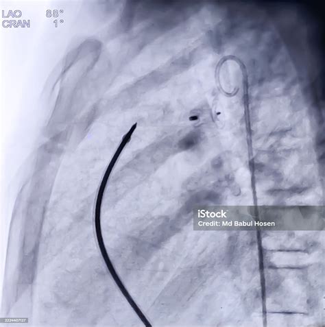 Patent Ductus Arteriosus Was Closed By Pda Closure Procedure In Cath