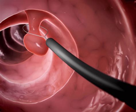 Polypectomy The Key To Preventing Colorectal Cancer And Why It Matters Polypectomy The Key To Preventing Colorectal Cancer And Why It Matters