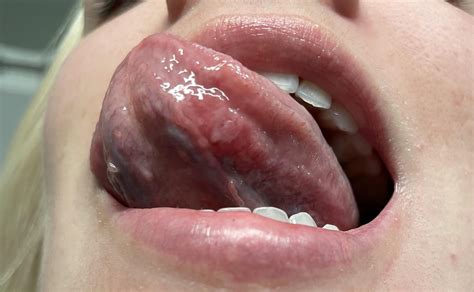 Major Apthous Ulcer Progression R Cankersores