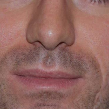 Subcision Technique Download Scientific Diagram