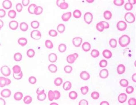 4 Hypochromic Microcytic Red Cells 53 Download Scientific Diagram