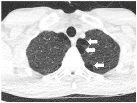 Aetiology Of Primary Spontaneous Pneumothorax