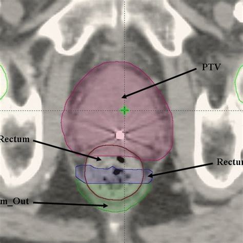 Pdf Comparison Of Hybrid Volumetric Modulated Arc Therapy Vmat Technique And Double Arc Vmat