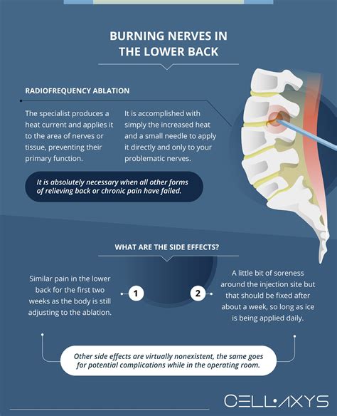 Risk Of Burning Nerves In The Lower Back Cellaxys