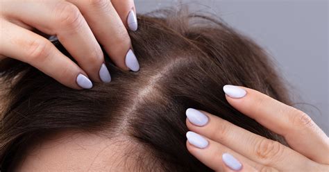 Scalp Psoriasis Vs Dandruff Experts Explain The Difference PS Beauty