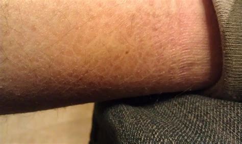 Dry Skin Patches Causes Symptoms Diagnosis And Treatments Dry