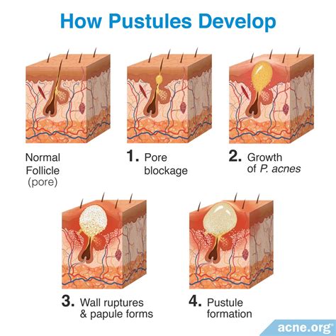 What Does Pimple Pus Look Like Under A Microscope At Dakota Bunce Blog
