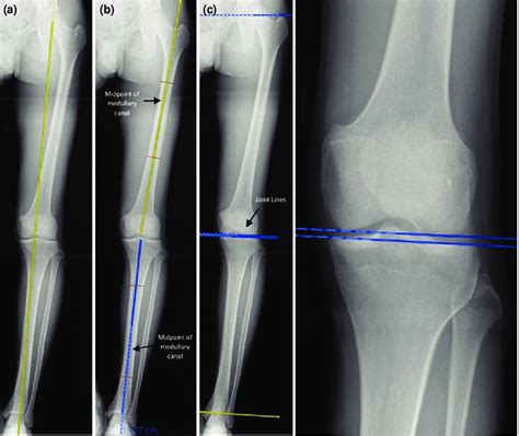 A Mechanical Axis Is Drawn From The Center Of Femoral Head To The