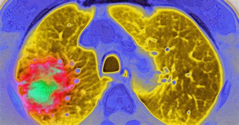 Lung Cancer Treatment Pfizers Lorbrena Extends Life In Some Non Small Cell Lung Cancers