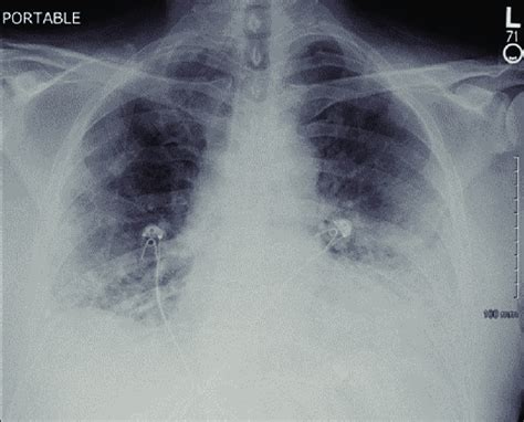 Repeat Chest X Ray Showing Bilateral Infiltrates Download Scientific Diagram