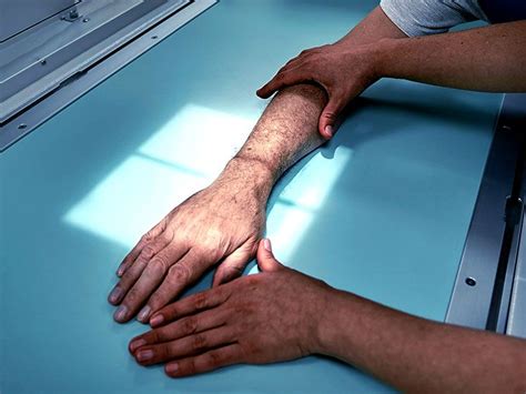 Scaphoid Fracture Treatment Symptoms And Recovery