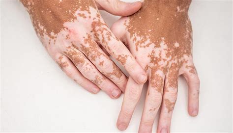 Skin Disorder Hiểu Rõ Về Các Rối Loạn Da Nguyên Nhân Và Cách Điều Trị