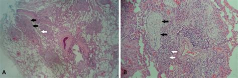 Micronodular Pattern Organising Pneumonia Mimicking Miliary Lung
