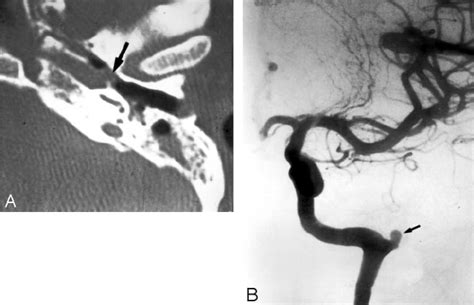 A 35 Year Old Woman Who Presented With Severe Recurrent Epistaxis A Download Scientific