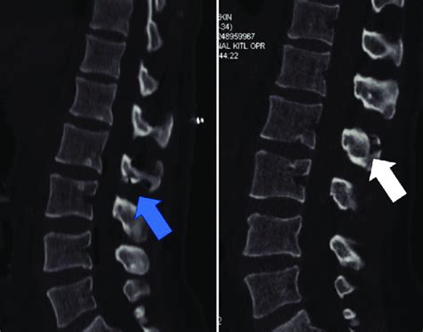 Patient No 4 Lumbar Schwannoma Performed L2 L3 Laminoplasty A