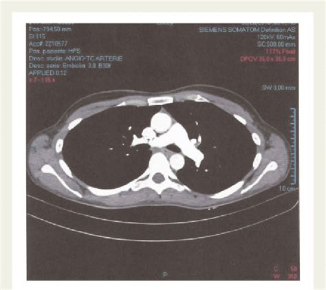 Computed Tomography Evidence Of Bilateral Subsegmental Pulmonary Embolism Download Scientific