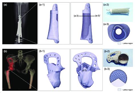 Ti 6ai 4v Hybrid Implant Post Surgery A Plain Radiography X Ray Of