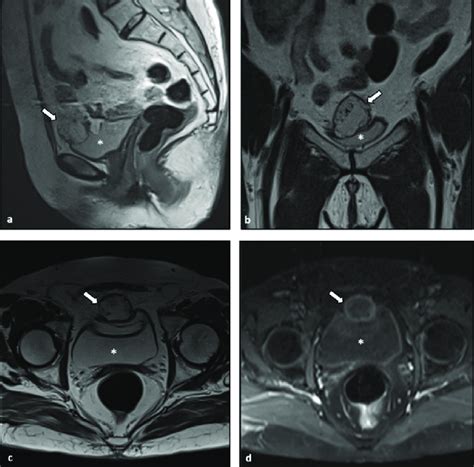 In The Anterior Segment Of The Bladder A Nodular Lesion Arrows With Download Scientific