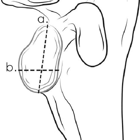 Dorsal View Of Left Scapula Indicating Glenoid Fossa Inclination And Download Scientific