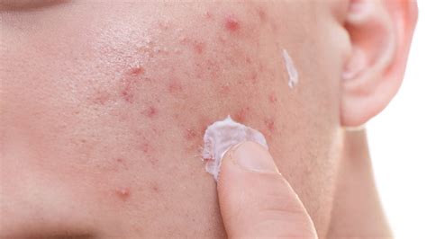 Kem Trị Mụn Derma Forte Cách Dùng Liều Lượng Và Lưu ý Khi Sử Dụng