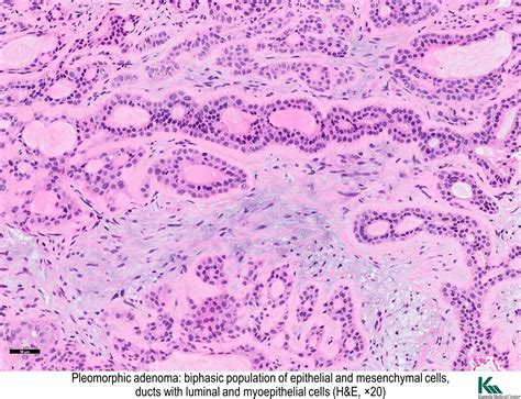 Pleomorphic Adenoma Pathology