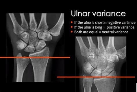 Ulnar Variance