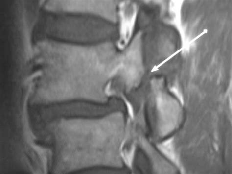 Daily Dose Pars Defect