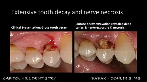 Save Or Extract A Significantly Decayed Tooth A Clinical Dilemma A
