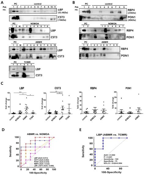Validation Of Urinary Exosomal Biomarker Candidates In Urine Exosome
