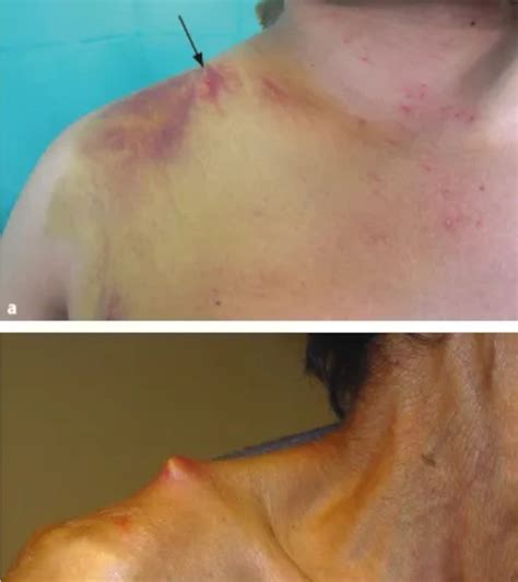 Mid Shaft Clavicle Fracture Sports Medicine Review