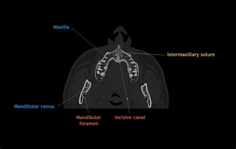 Maxillofacial Ct Anatomy Imaging Anatomy Of Maxillofacial Region