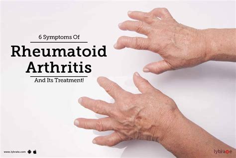 Symptoms Of Rheumatoid Arthritis And Its Treatment By Bansal Hospital Lybrate