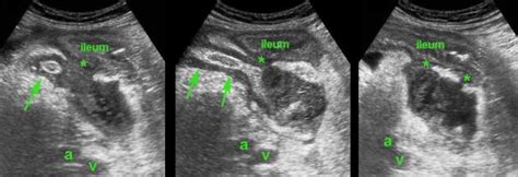 The Radiology Assistant Appendicitis Us Findings