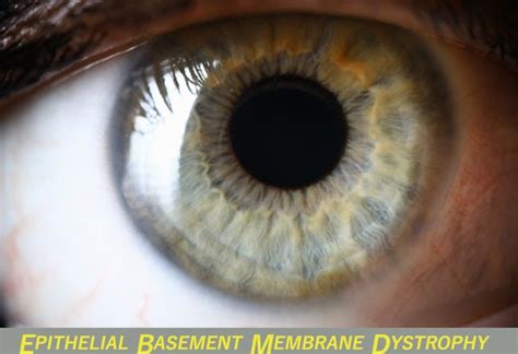 Epithelial Basement Membrane Dystrophy Archives Planet Ayurveda