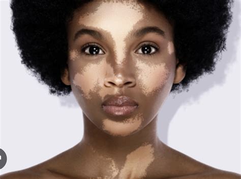 Understanding Vitiligo Ecc Services