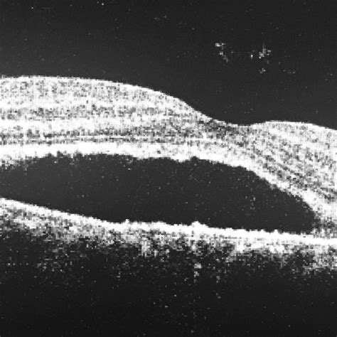 Oct Image Of A Case With Vitreomacular Adhesion In The Control Group