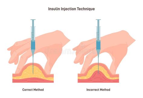 Insulin Injection Skin Stock Illustrations 117 Insulin Injection Skin Stock Illustrations