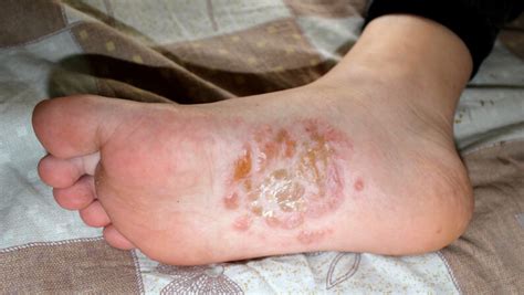What Is Dyshidrotic Eczema Team Dermatology