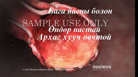 Уушгины хатгалгаа гэж юу вэ Хүндрэл Youtube