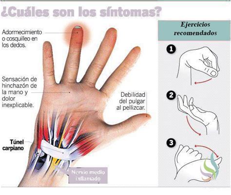 ¿qué Es El Síndrome Del Túnel Carpiano